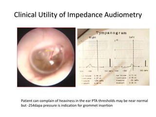 Clncal utility of impedance audiometry | PPTX | Ear, Nose and Throat ...