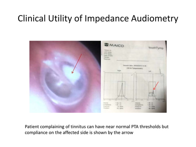 Clncal utility of impedance audiometry | PPTX | Ear, Nose and Throat ...