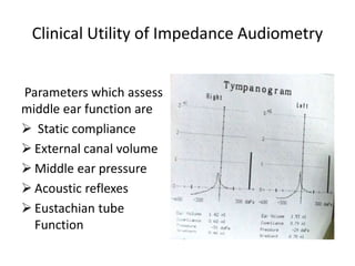 Clncal utility of impedance audiometry | PPTX | Ear, Nose and Throat Conditions | Diseases and ...