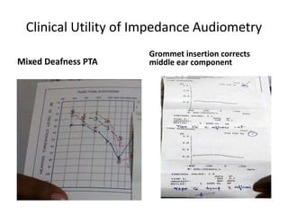 Clncal utility of impedance audiometry | PPTX