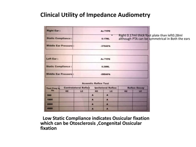 Clncal utility of impedance audiometry | PPTX | Ear, Nose and Throat ...