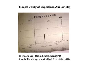 Clncal utility of impedance audiometry | PPTX | Ear, Nose and Throat ...