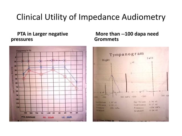 Clncal utility of impedance audiometry | PPTX | Ear, Nose and Throat ...