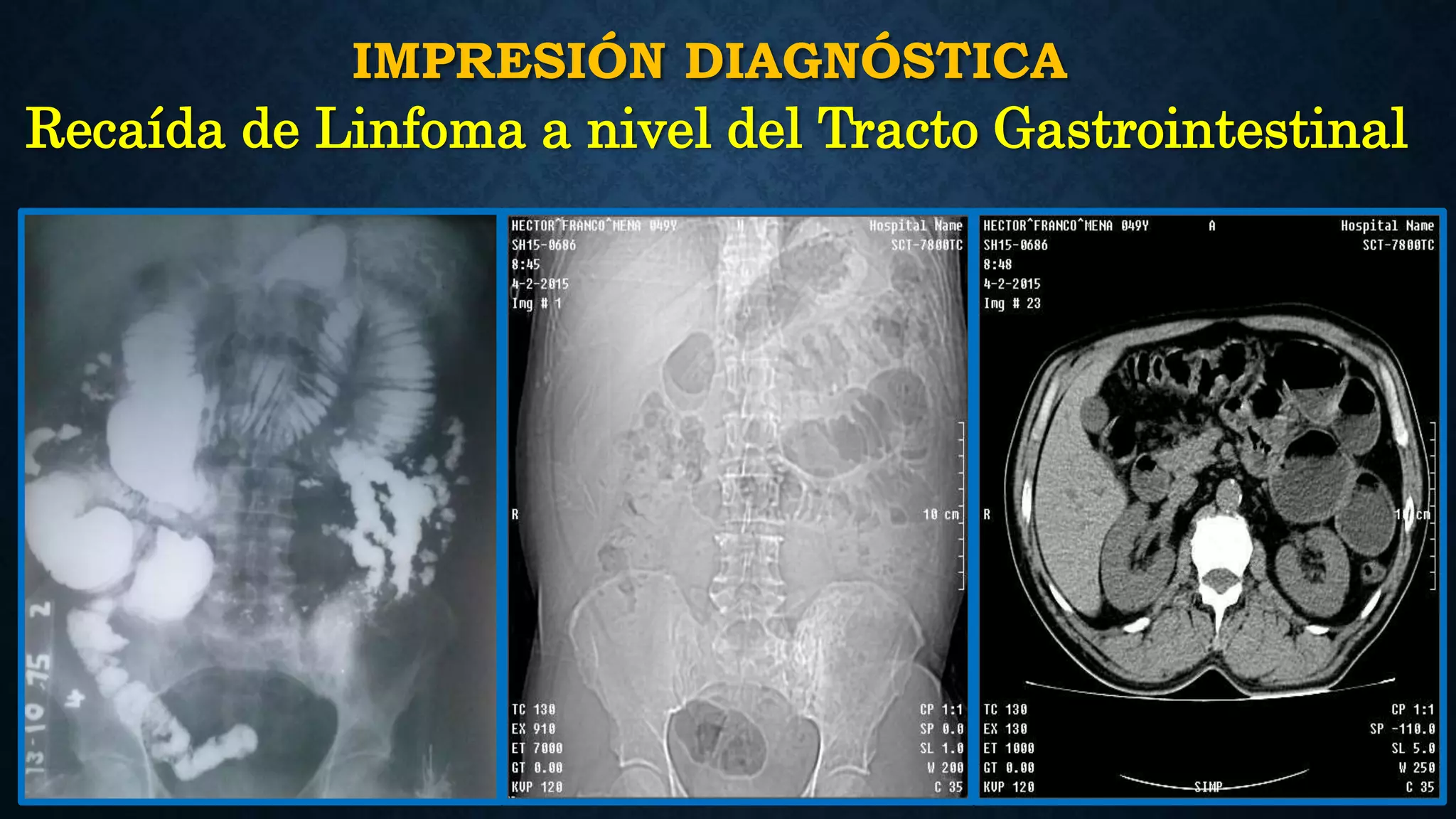 Linfoma del tracto gastroIntestinal Clínico radiológica | PPTX ...