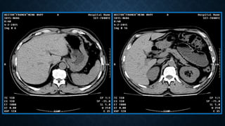 Linfoma del tracto gastroIntestinal Clínico radiológica | PPTX ...