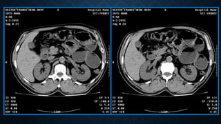 Linfoma del tracto gastroIntestinal Clínico radiológica | PPTX ...