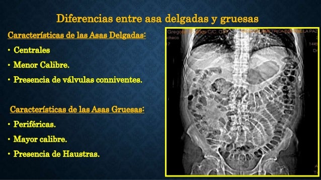 Linfoma del tracto gastroIntestinal Clínico radiológica