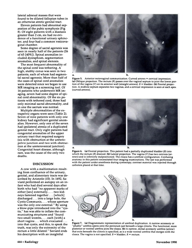 Cloacal malformation.full | Digestive Disorders | Diseases and Conditions