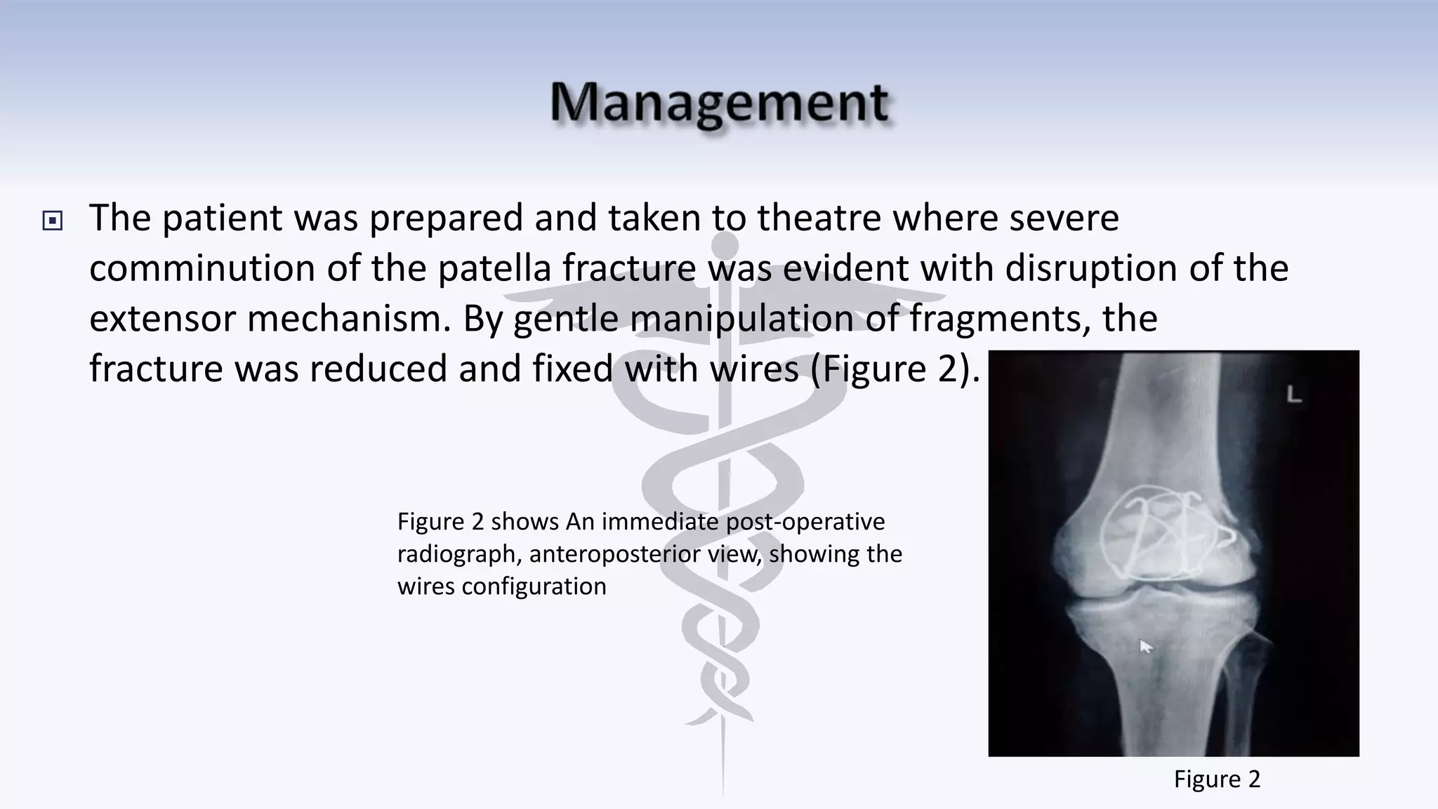 comminuted fracture of left patellar with displacement case ...