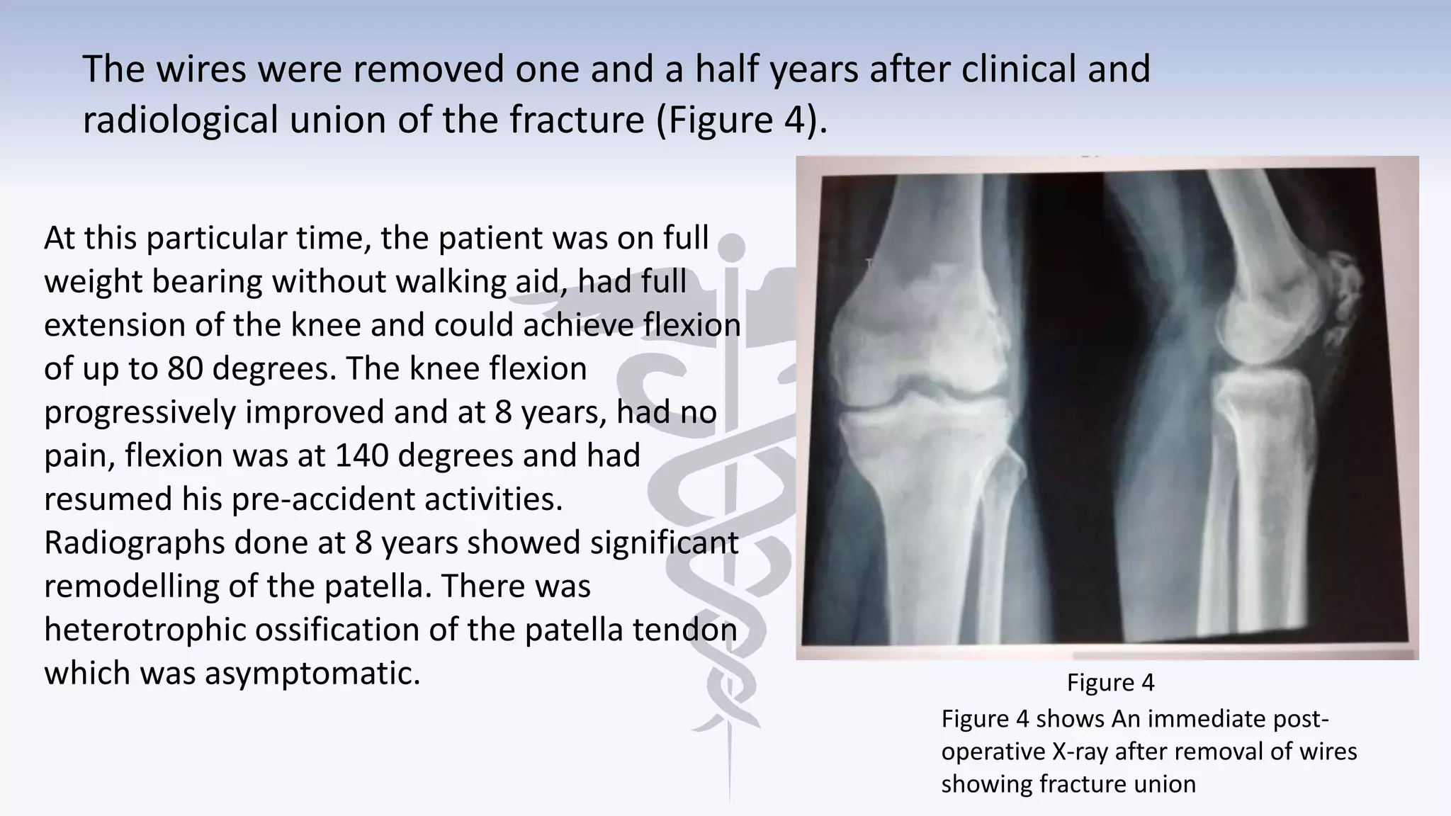 comminuted fracture of left patellar with displacement case ...
