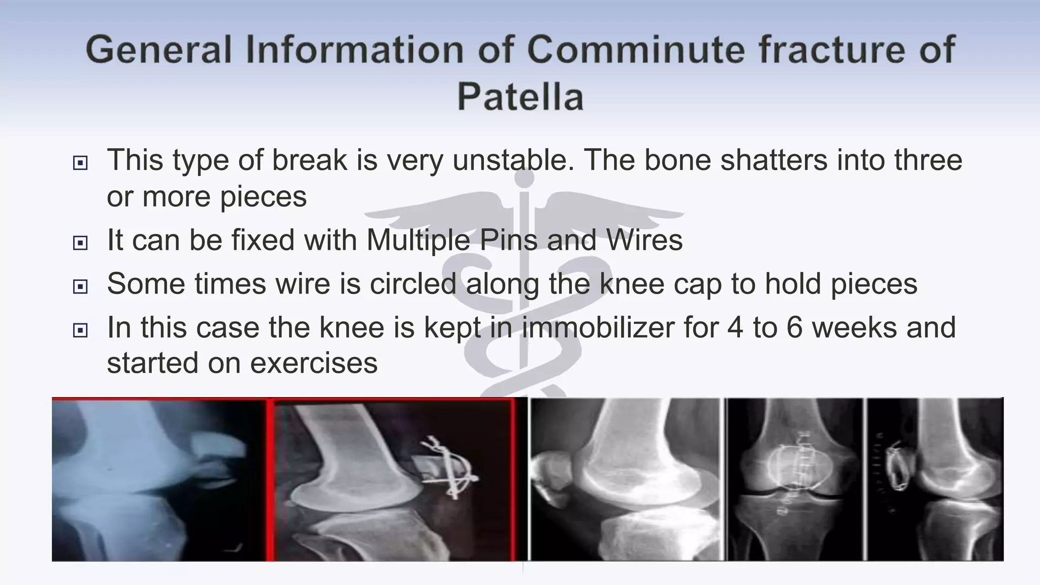 comminuted fracture of left patellar with displacement case ...
