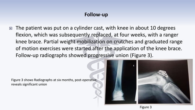 comminuted fracture of left patellar with displacement case ...