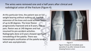 comminuted fracture of left patellar with displacement case ...