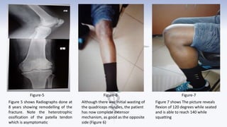comminuted fracture of left patellar with displacement case ...