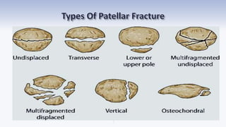 comminuted fracture of left patellar with displacement case ...