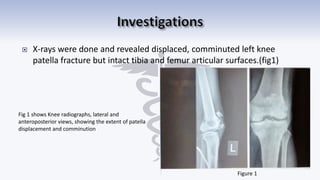 comminuted fracture of left patellar with displacement case ...