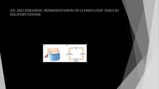 Closed loop (automated) insulin delivery | PPTX