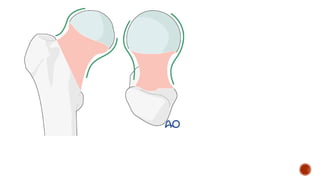 closed reduction techniques in neck of femur fracture.pptx