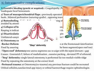 Closed rhinoplasty | PPT