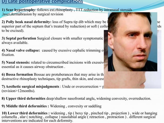 Closed rhinoplasty | PPT