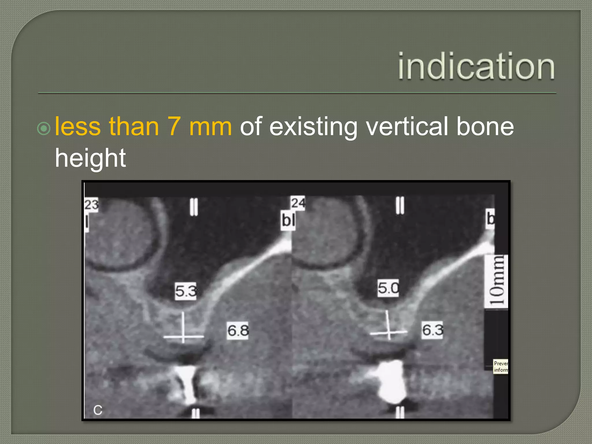 Closed Sinus Lift Surgery | PPTX