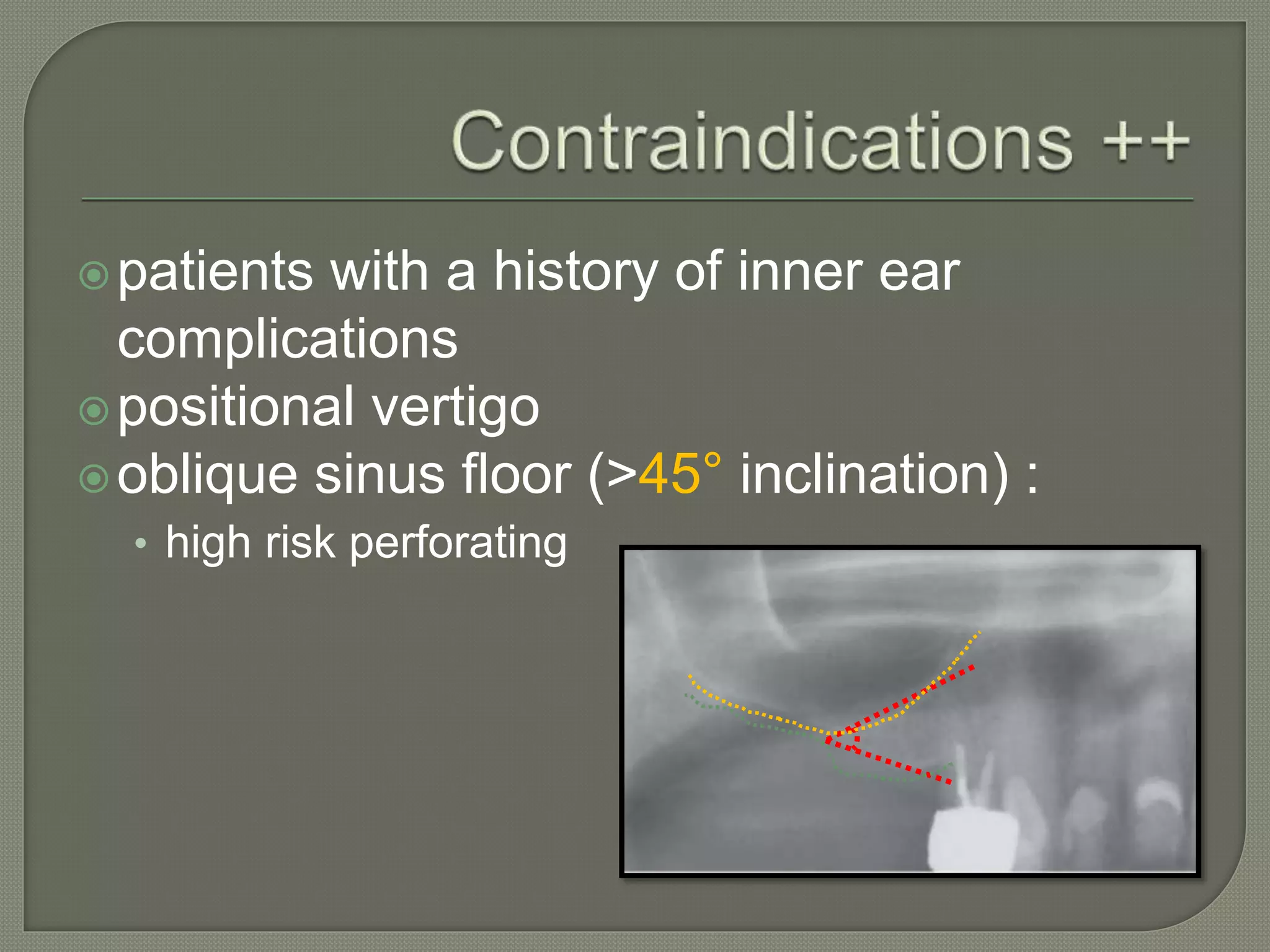 Closed Sinus Lift Surgery | PPTX