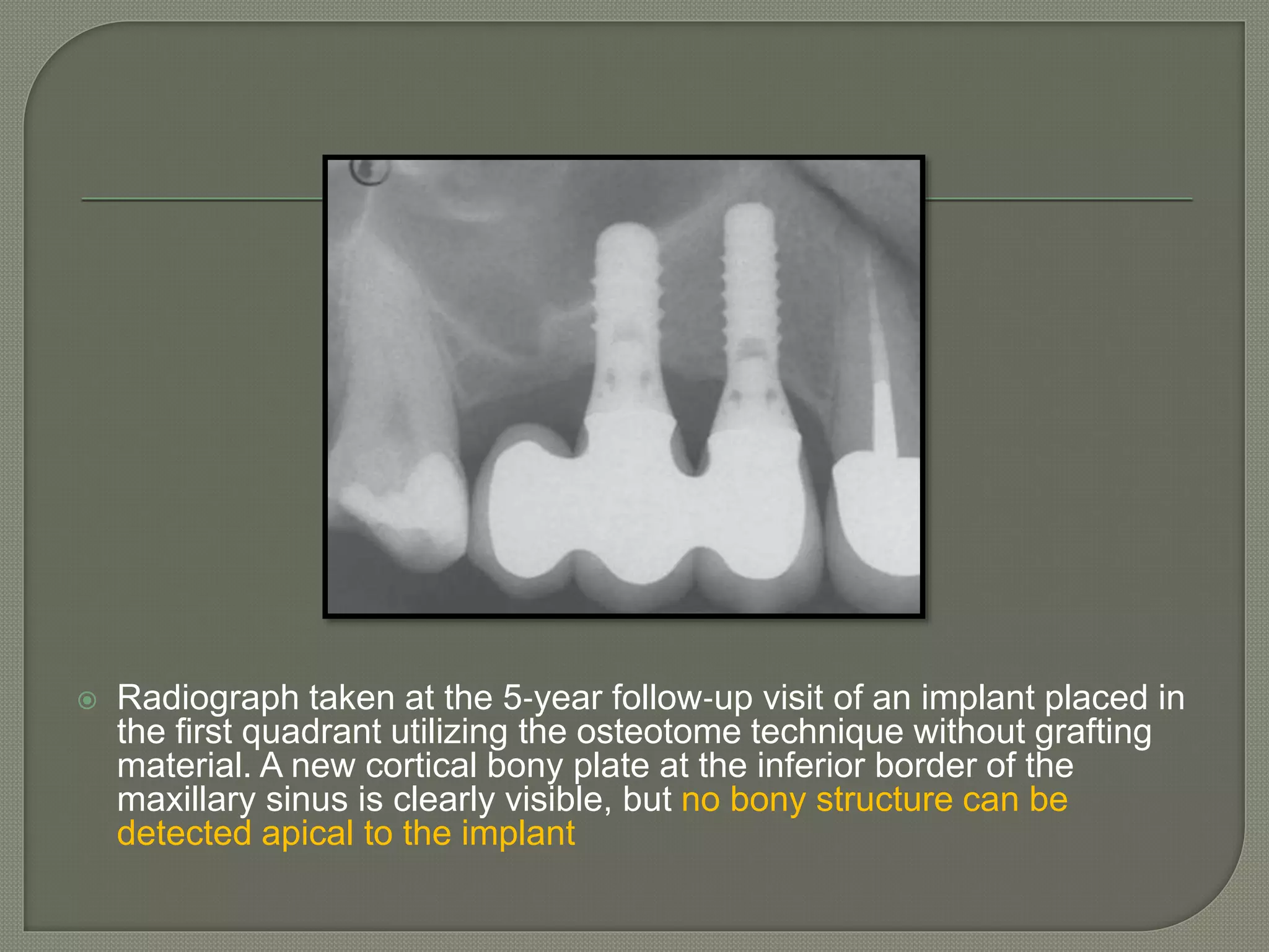 Closed Sinus Lift Surgery | PPTX