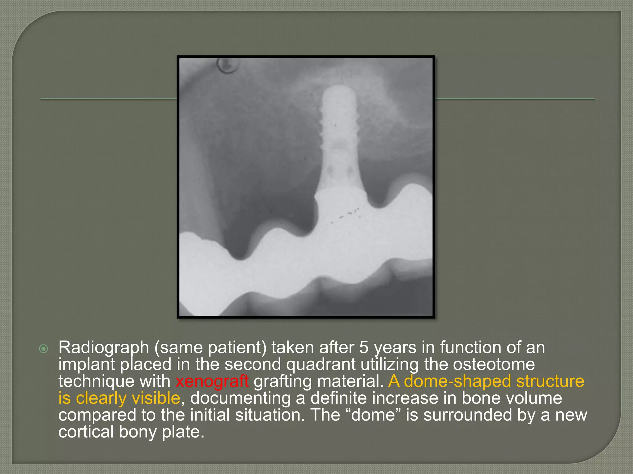 Closed Sinus Lift Surgery | PPTX