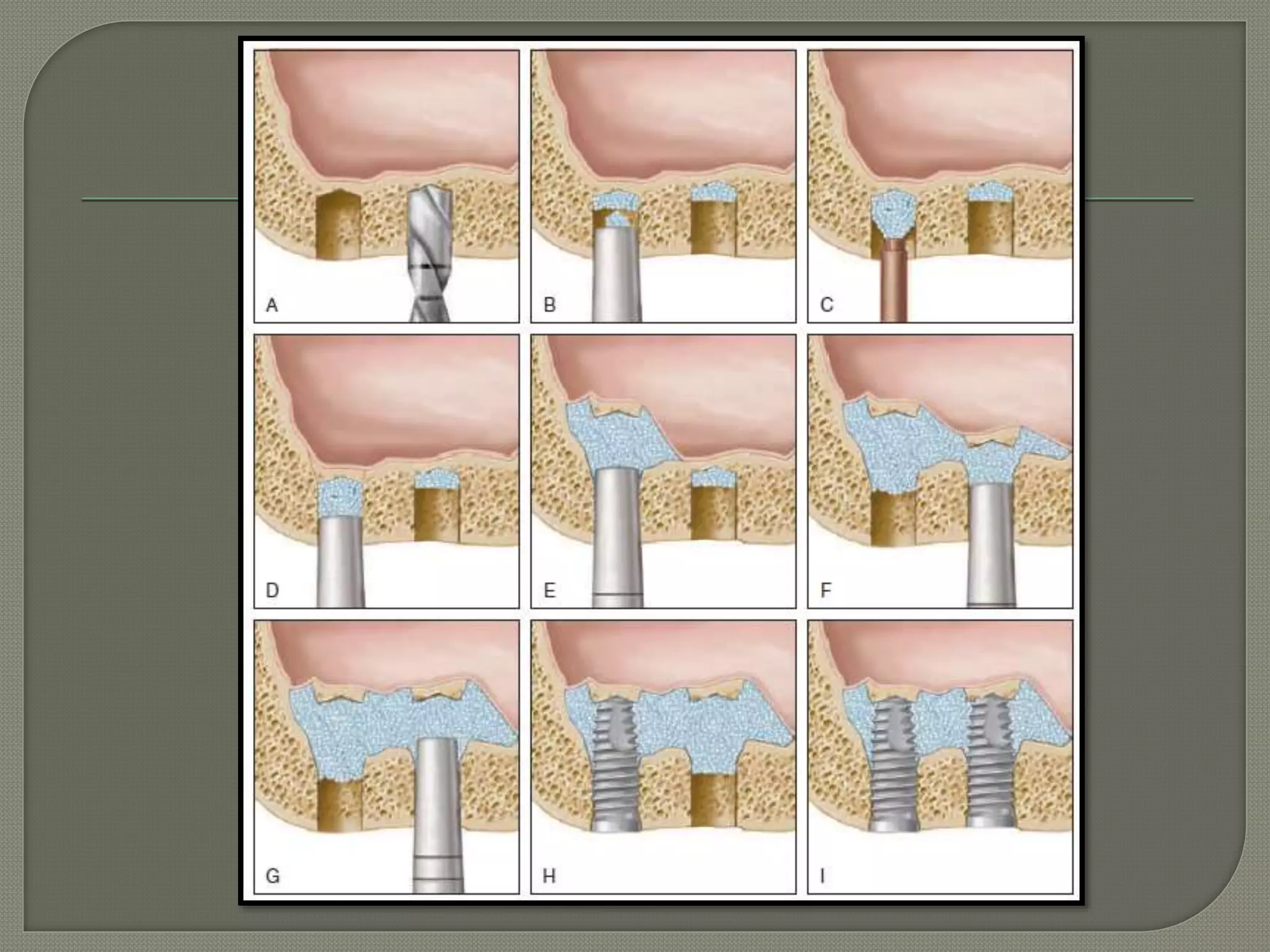 Closed Sinus Lift Surgery | PPTX