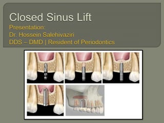 Closed Sinus Lift Surgery | PPTX