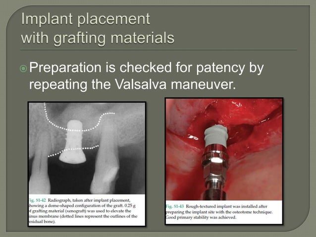 Closed Sinus Lift Surgery | PPTX