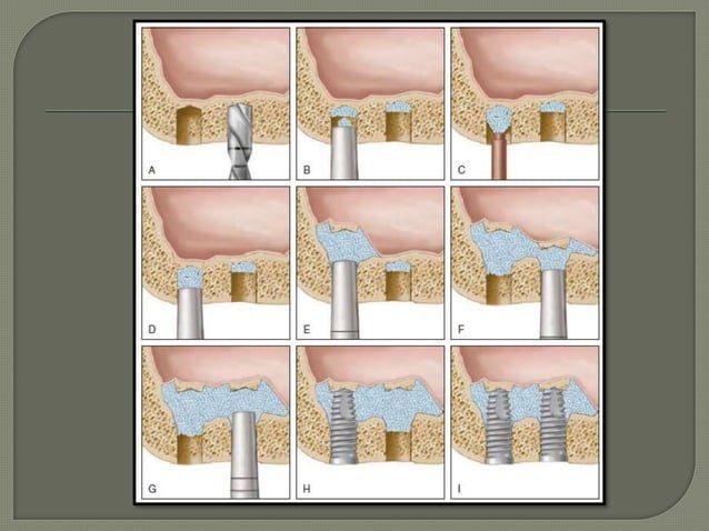 Closed Sinus Lift Surgery | PPTX