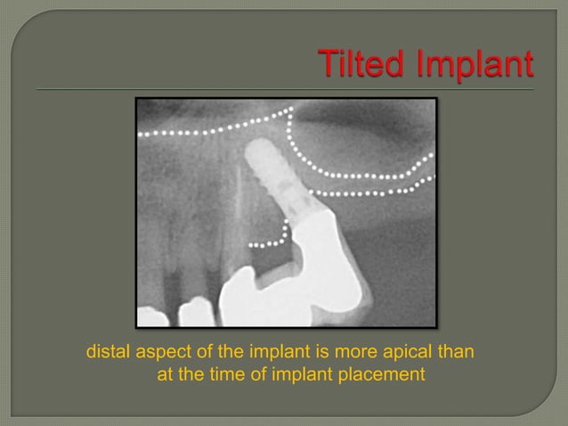 Closed Sinus Lift Surgery | PPTX