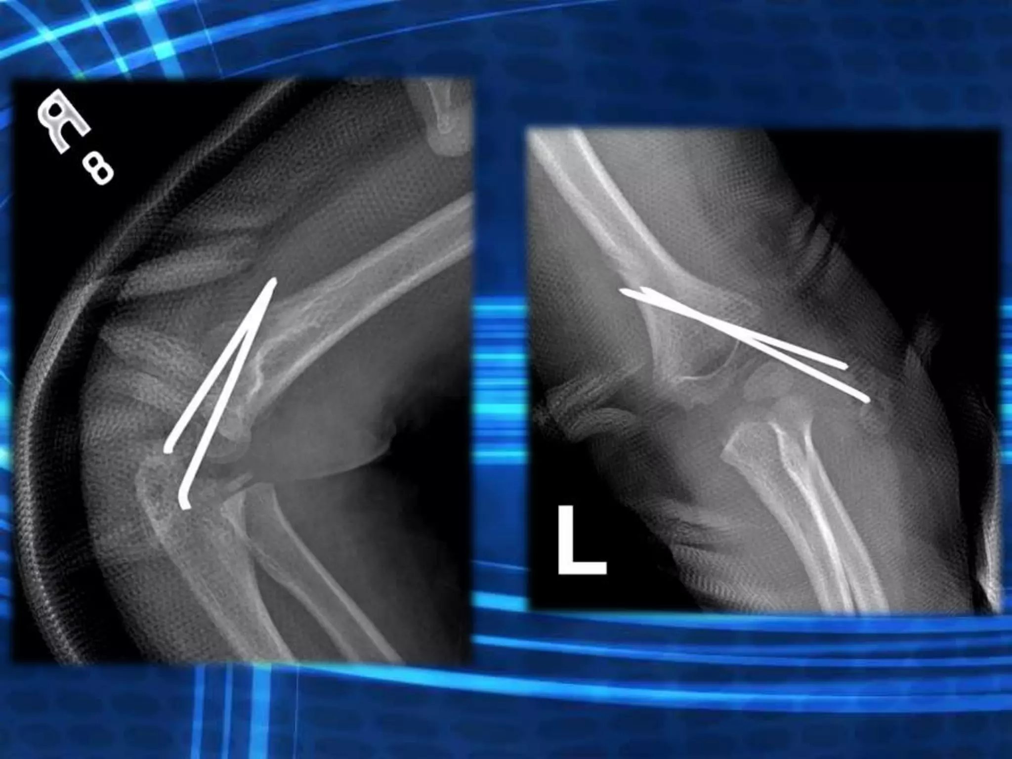 Closed vs. open reduction in lateral condylar fractures of humerus in ...