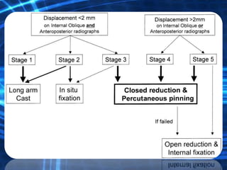Closed vs. open reduction in lateral condylar fractures of humerus in ...