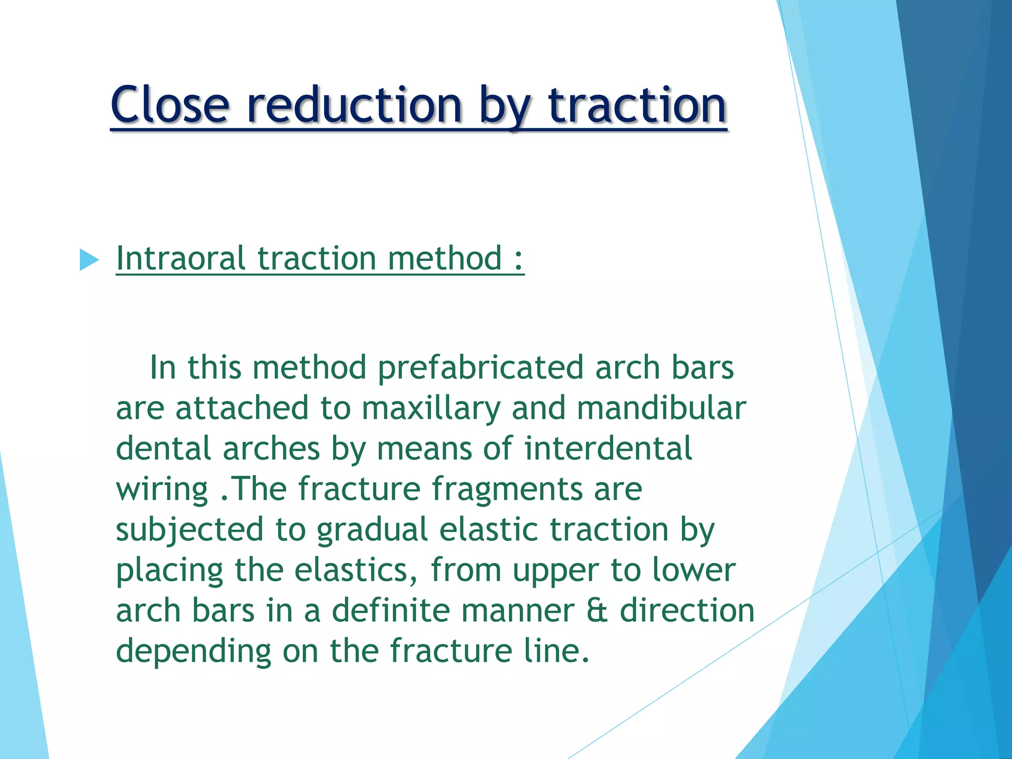 Closed Reduction in Mandibular Fractures | PPTX