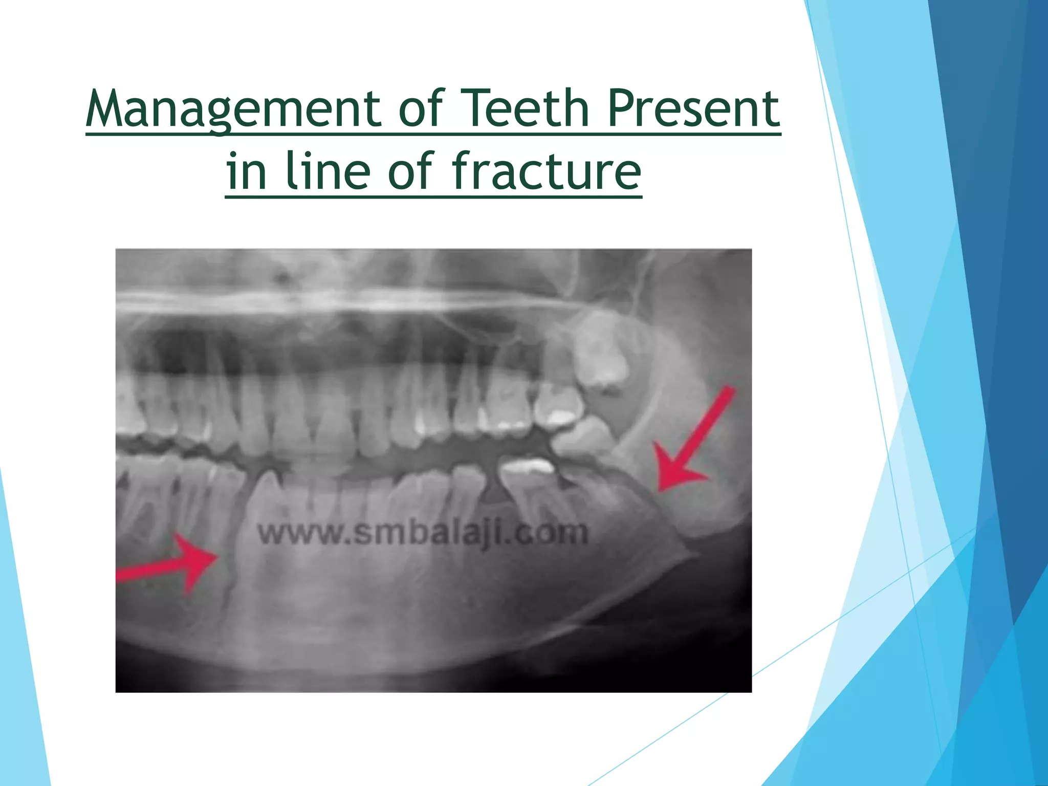 Closed Reduction in Mandibular Fractures | PPTX