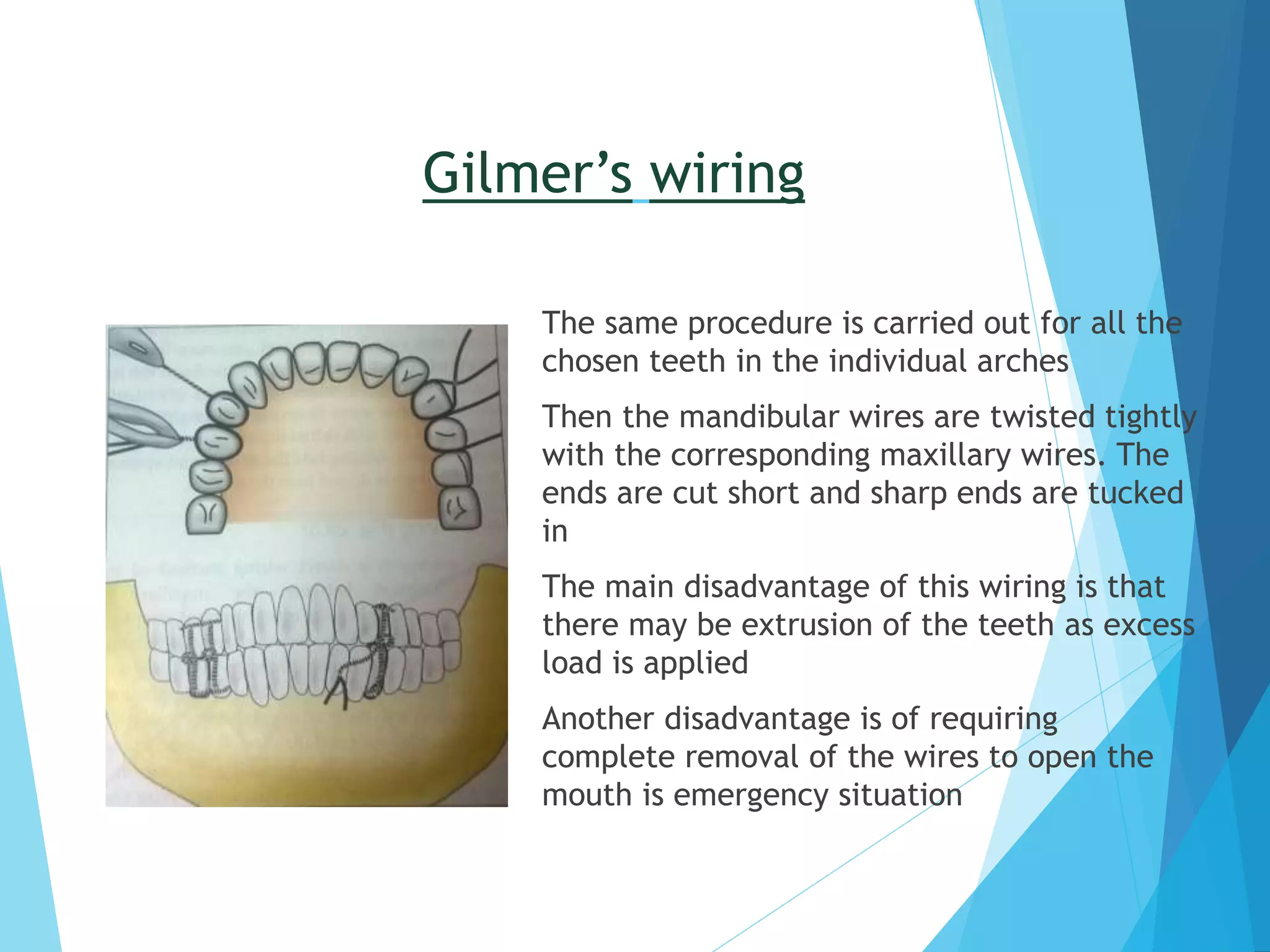 Closed Reduction in Mandibular Fractures | PPTX