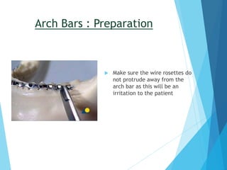 Closed Reduction in Mandibular Fractures | PPTX