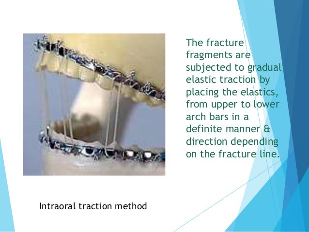 Closed Reduction in Mandibular Fractures