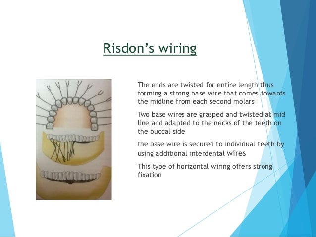 Closed Reduction in Mandibular Fractures