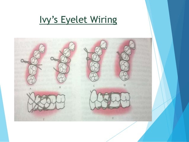 Closed Reduction in Mandibular Fractures