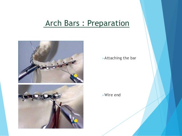 Closed Reduction in Mandibular Fractures