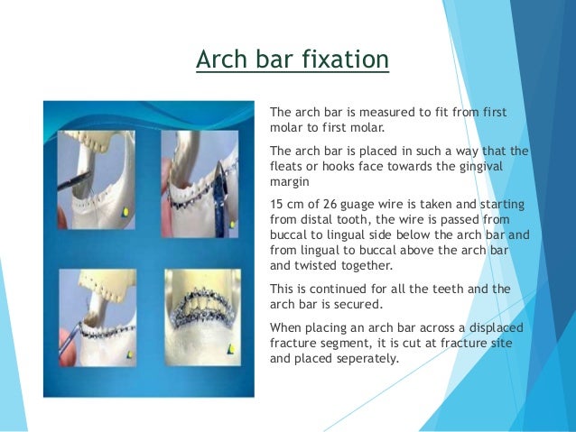 Closed Reduction in Mandibular Fractures