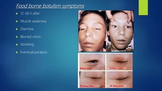 Botulism Disease