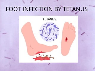 CLOSTRIDIUM TETANI A overview of SlideShare | PPTX