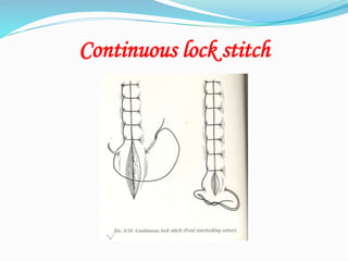 Lock Stitch Suture