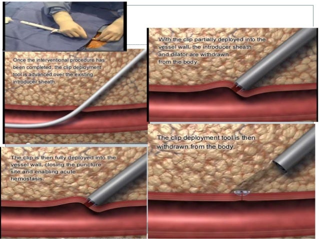 Closure Devices