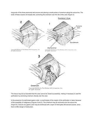 Closure of perforation | PDF
