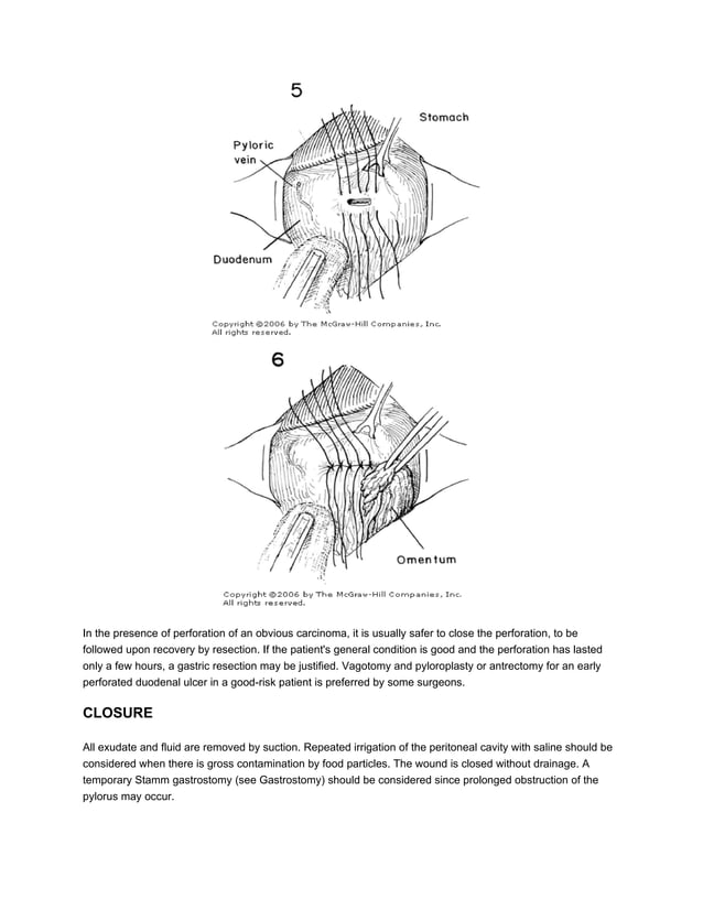 Closure of perforation | PDF